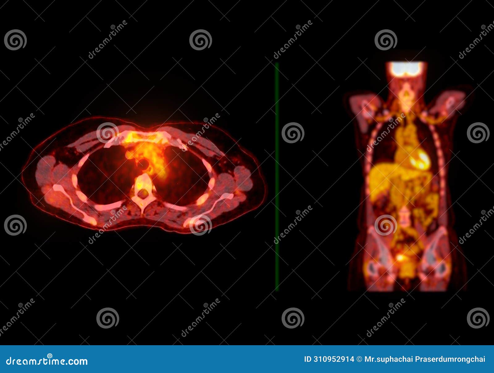 A PET-CT Scan Image is a Diagnostic Visualization Combining Positron ...