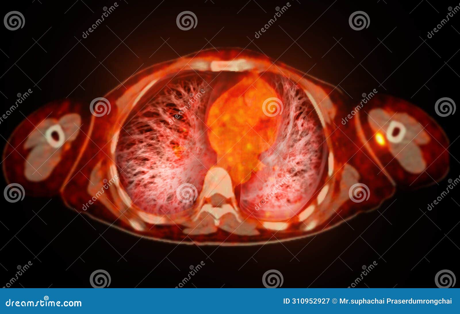 A PET-CT Scan Image is a Diagnostic Visualization Combining Positron ...