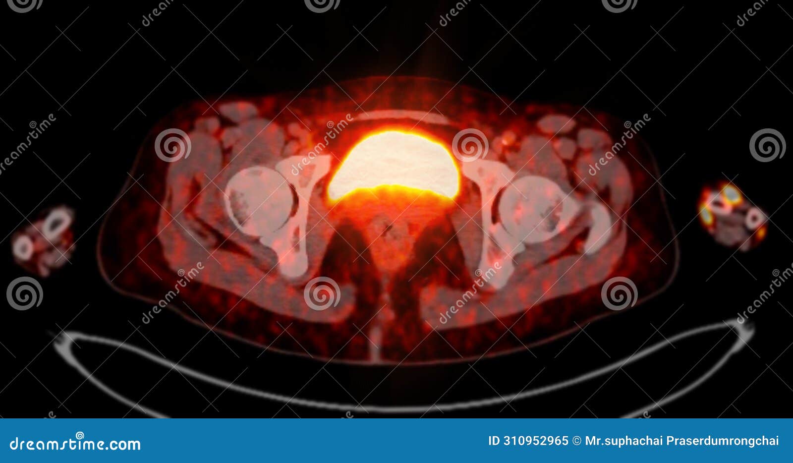 A PET-CT Scan Image is a Diagnostic Visualization Combining Positron ...
