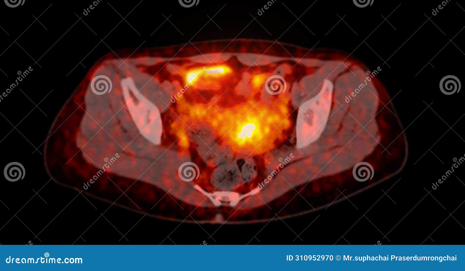 A PET-CT Scan Image is a Diagnostic Visualization Combining Positron ...