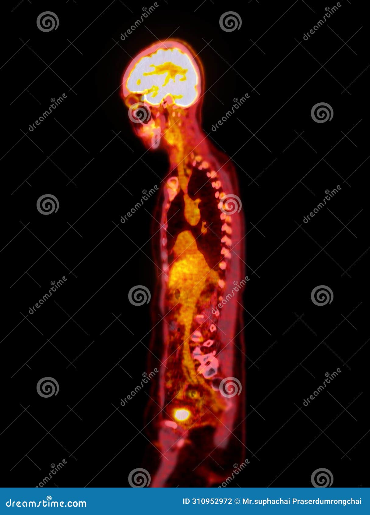 A PET-CT Scan Image is a Diagnostic Visualization Combining Positron ...