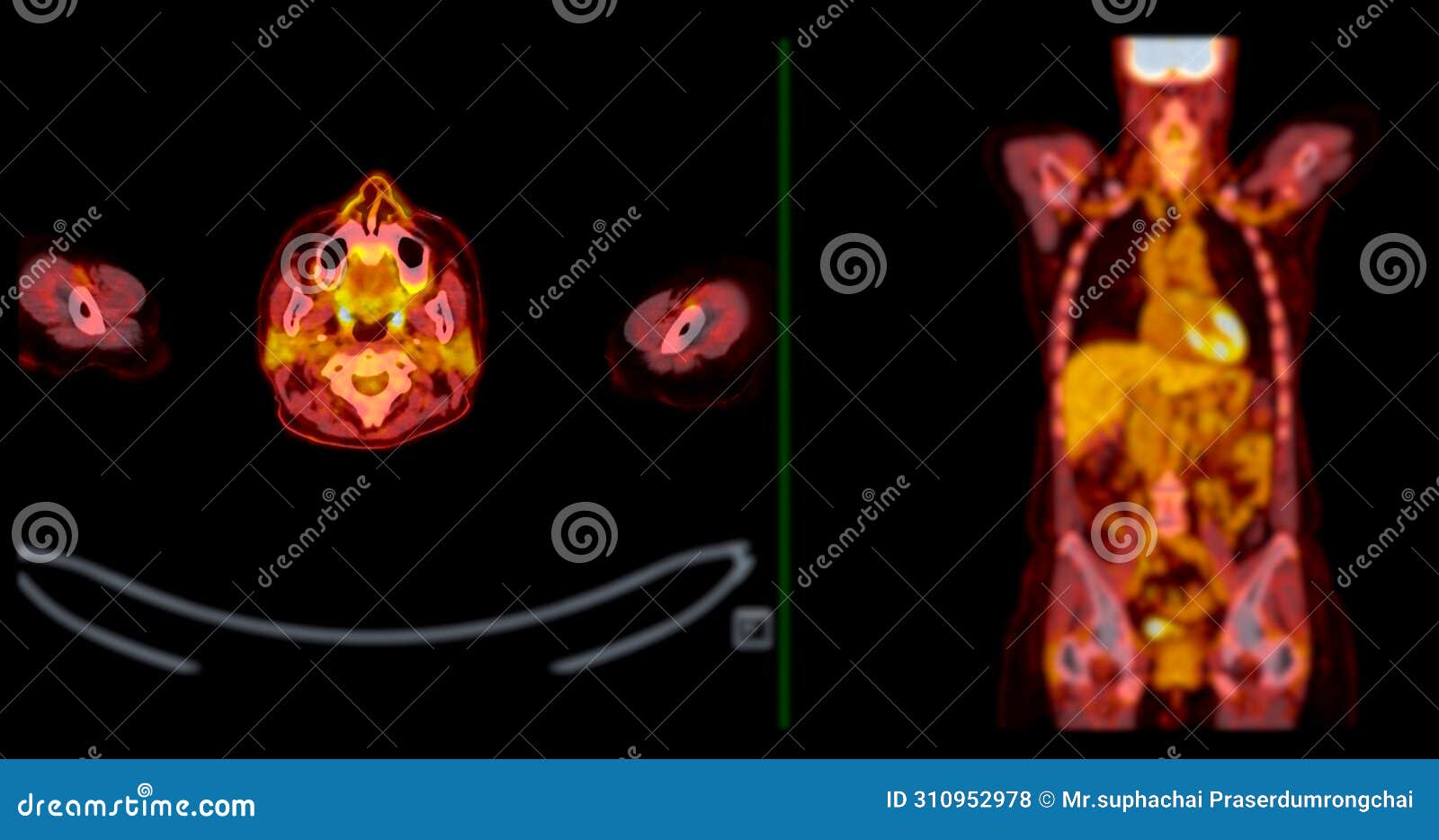 A PET-CT Scan Image is a Diagnostic Visualization Combining Positron ...