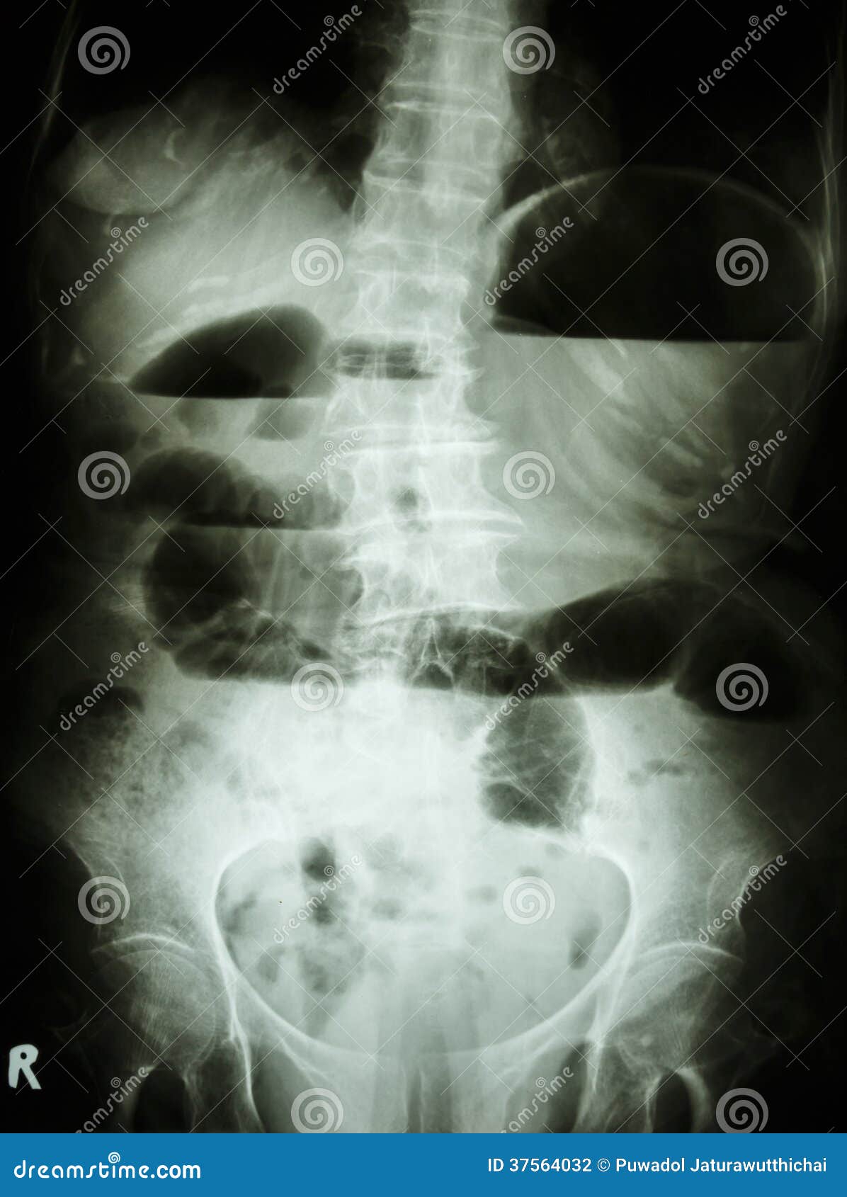 Petite Obstruction D'entrailles Photo stock - Image du soin, diagnostic ...