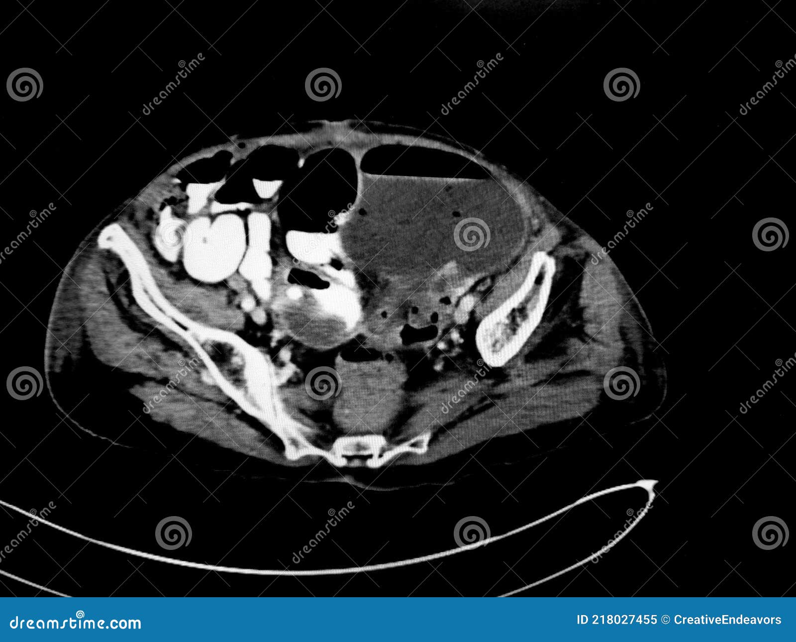 Petite Occlusion Intestinale Scanner De L'abdomen Image stock - Image ...