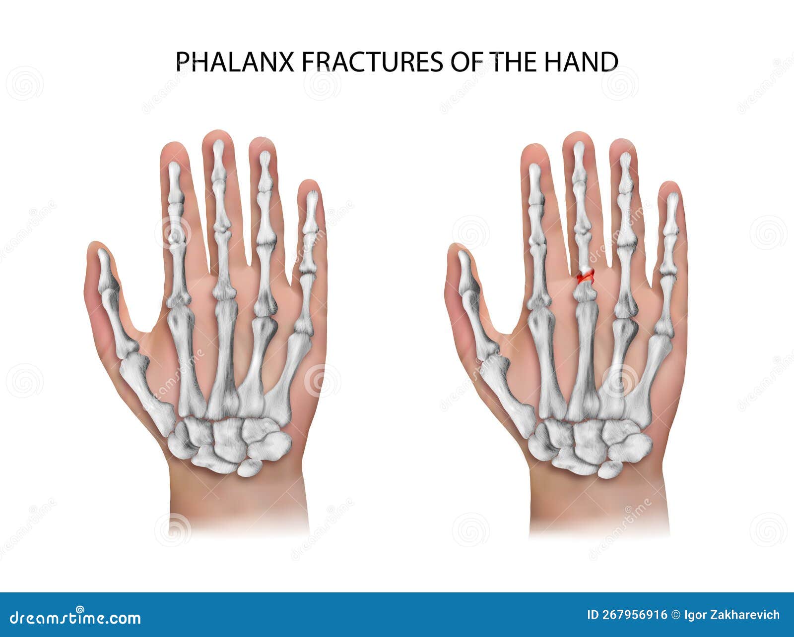 Phalanx Fractures of the Hand. Stock Illustration - Illustration of ...