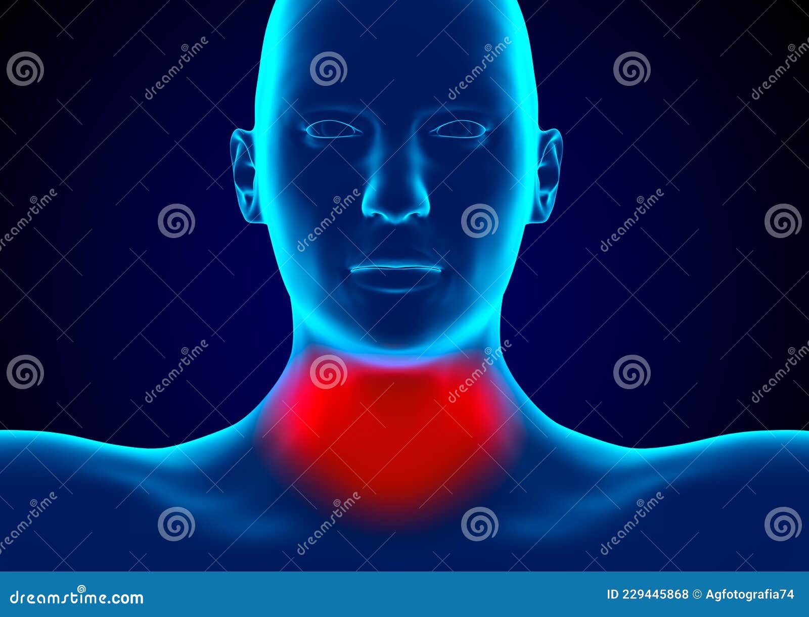Pharyngitis is an Infection of the Pharynx Caused by Bacteria of the ...