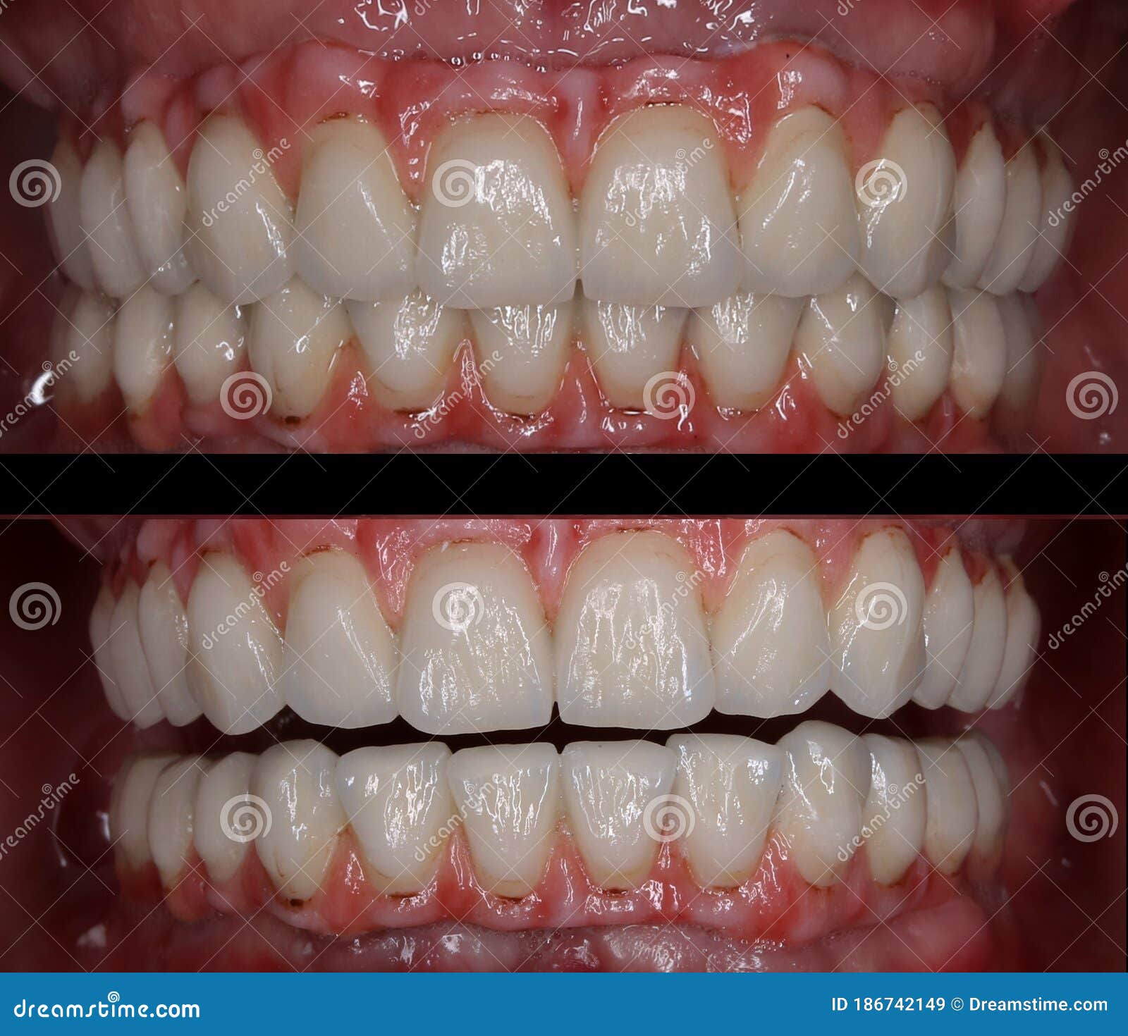 Photo of the ceramic teeth stock image. Image of cosmetic - 186742149