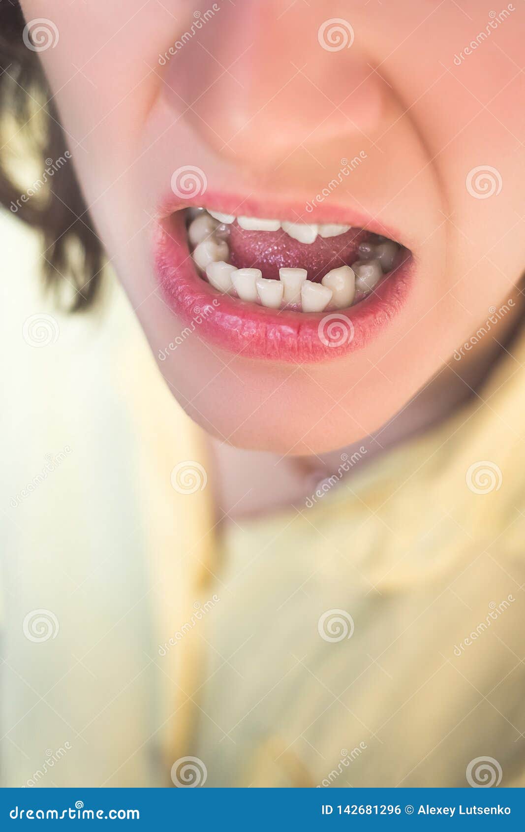 Photo of Crooked Woman Teeth Stock Photo - Image of install, close ...