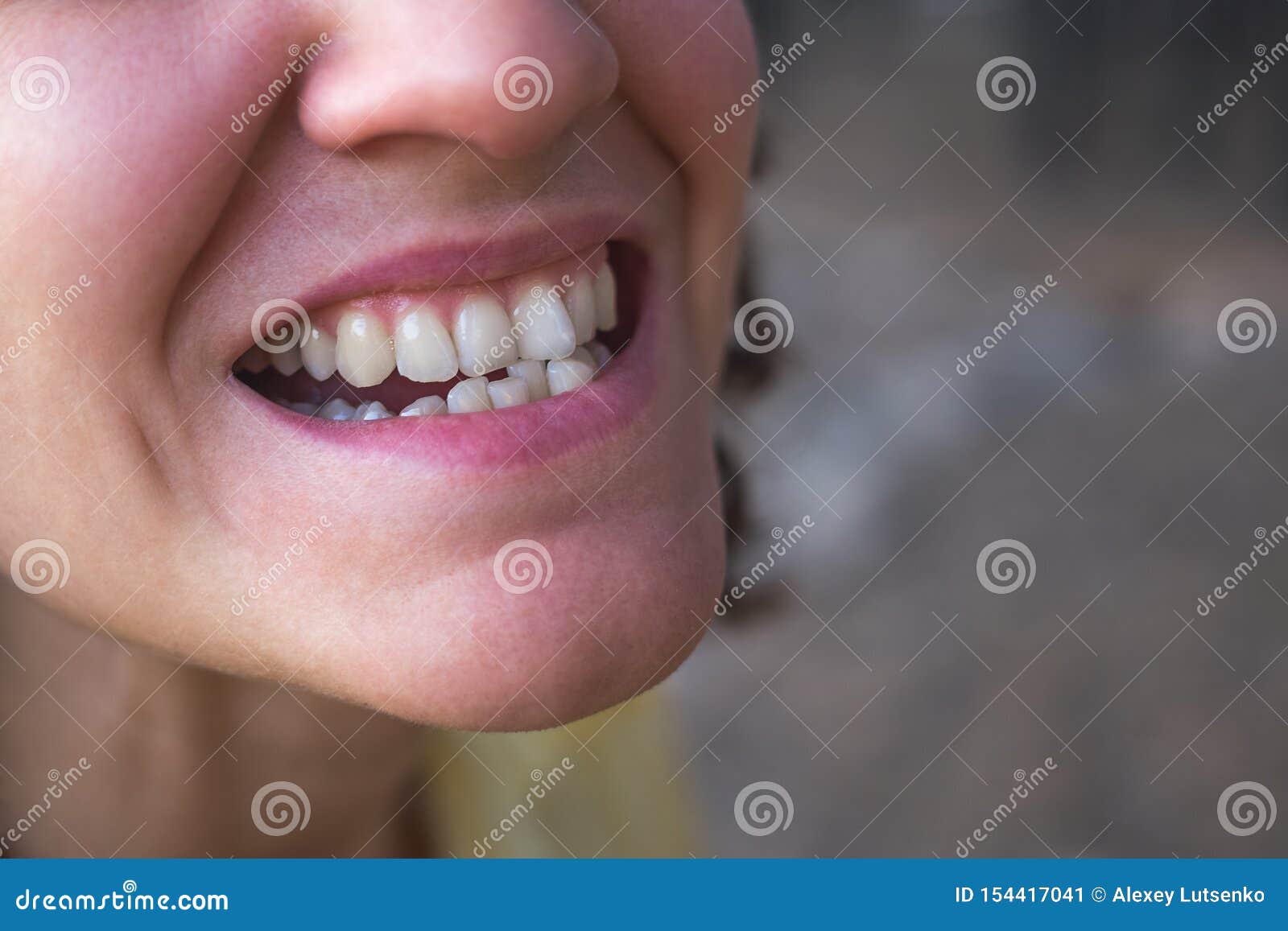 Photo of Crooked Woman Teeth Stock Image - Image of disease ...