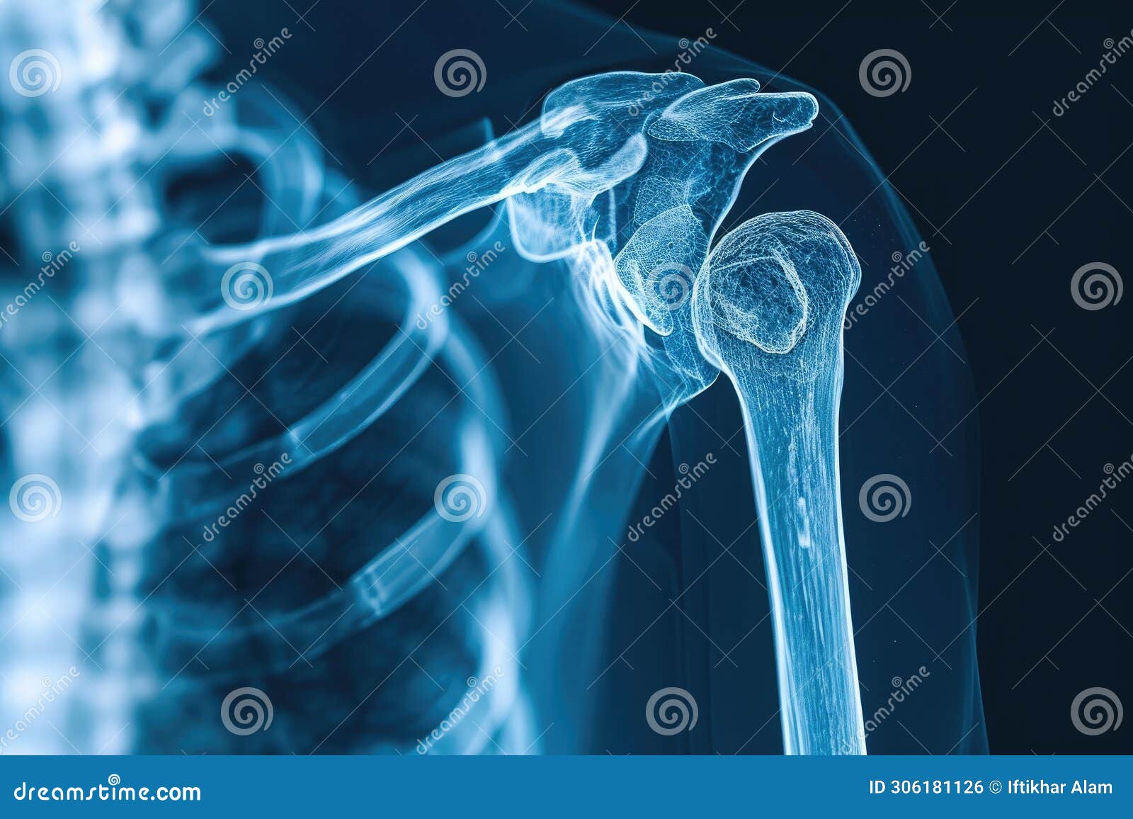 This Photo Depicts an X-ray Image of the Shoulder and the Bones within ...