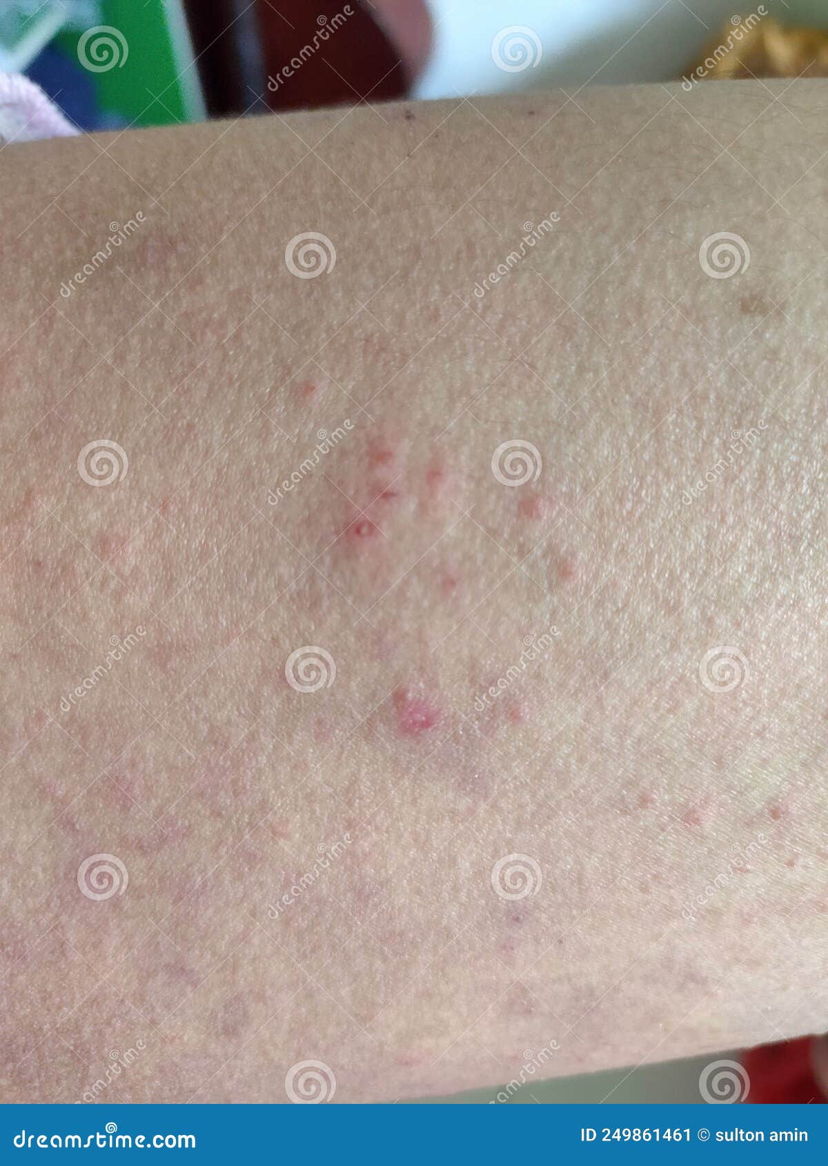 Photo Itchy Disease Caused by Fleas Stock Image - Image of face, circle ...