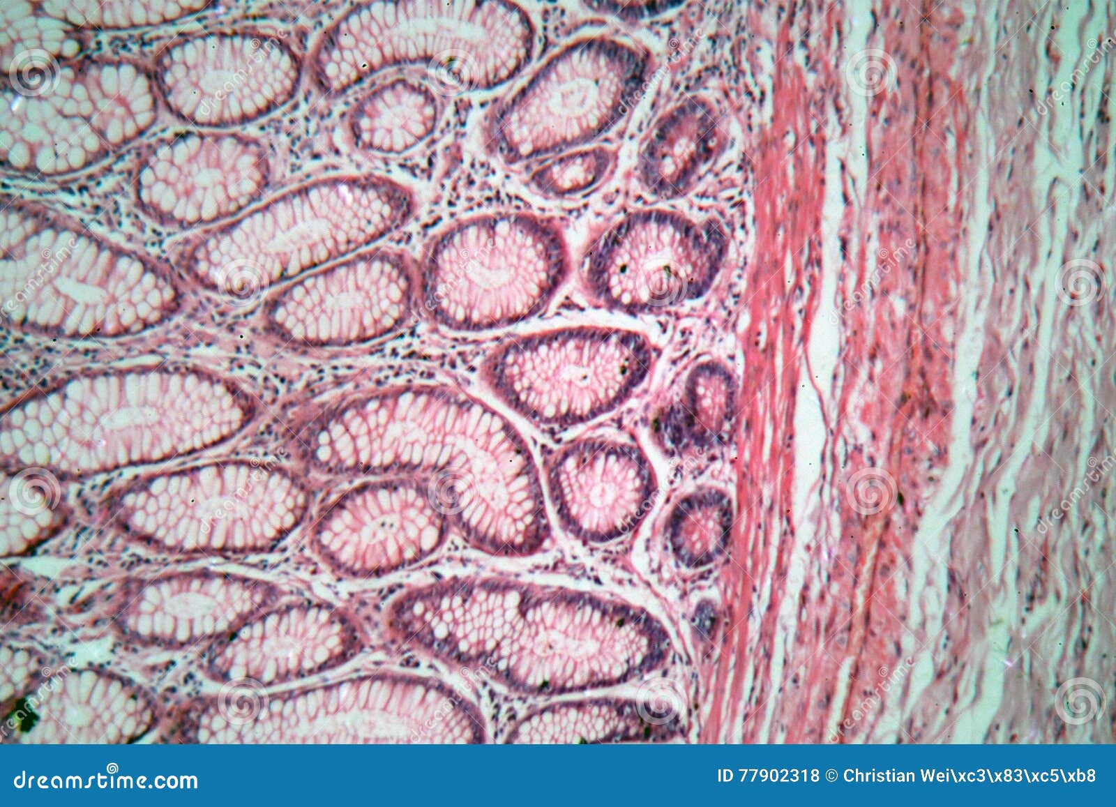 Photo of Large Intestine Cells. Stock Photo - Image of disease ...