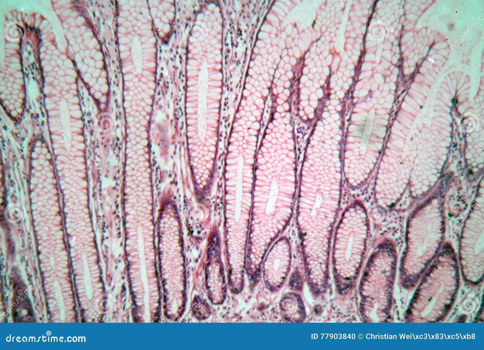 Photo of Large Intestine Cells. Stock Photo - Image of sickness ...