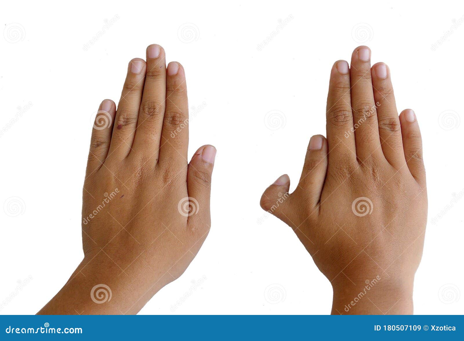 Isolation Photo of Polydactyly on Human; Rare Abnormal Characteristic ...