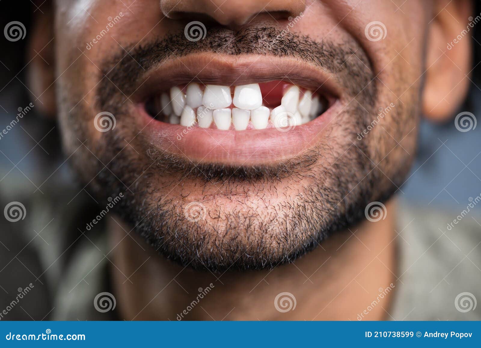 Photo of Young Man with Missing Tooth Stock Image - Image of african ...