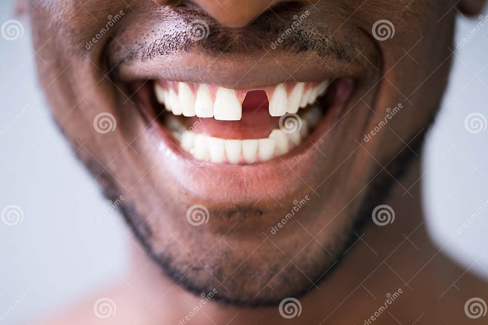 Photo of Young Man with Missing Tooth Stock Photo - Image of human ...