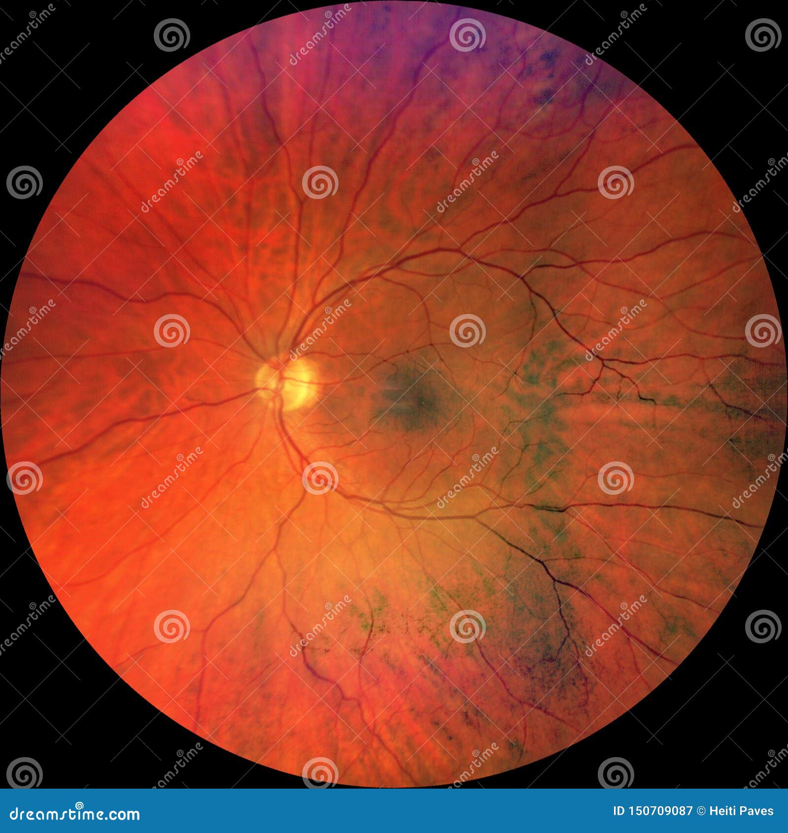 Photograph of the Fundus Oculi Stock Image - Image of photograph, human ...