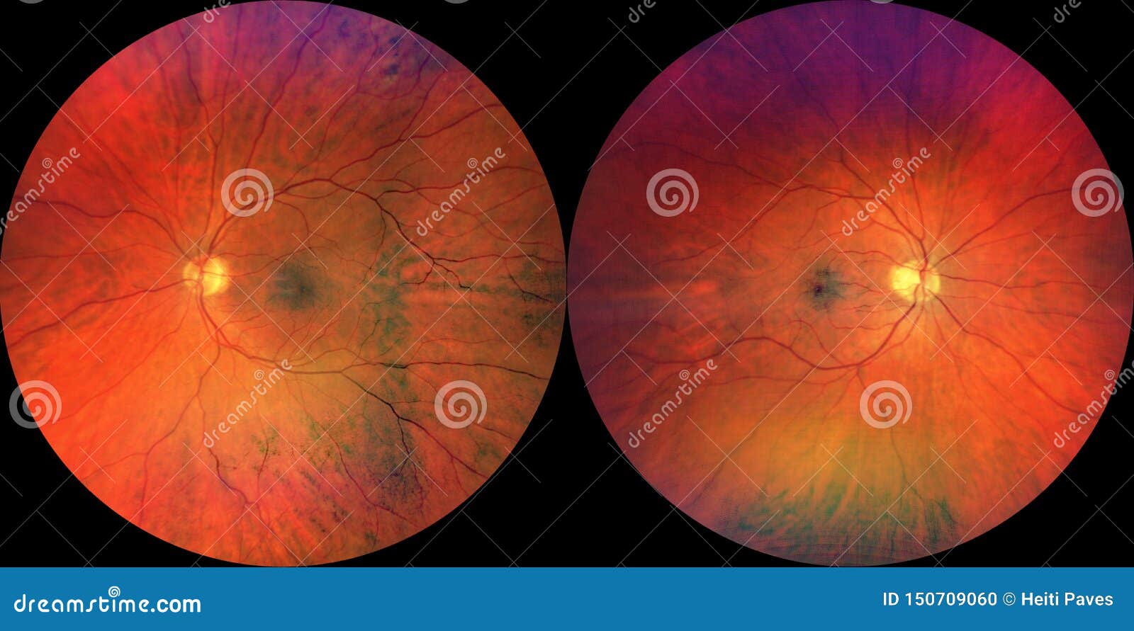 Photograph of the Fundus Oculi Stock Photo - Image of camera, posterior ...