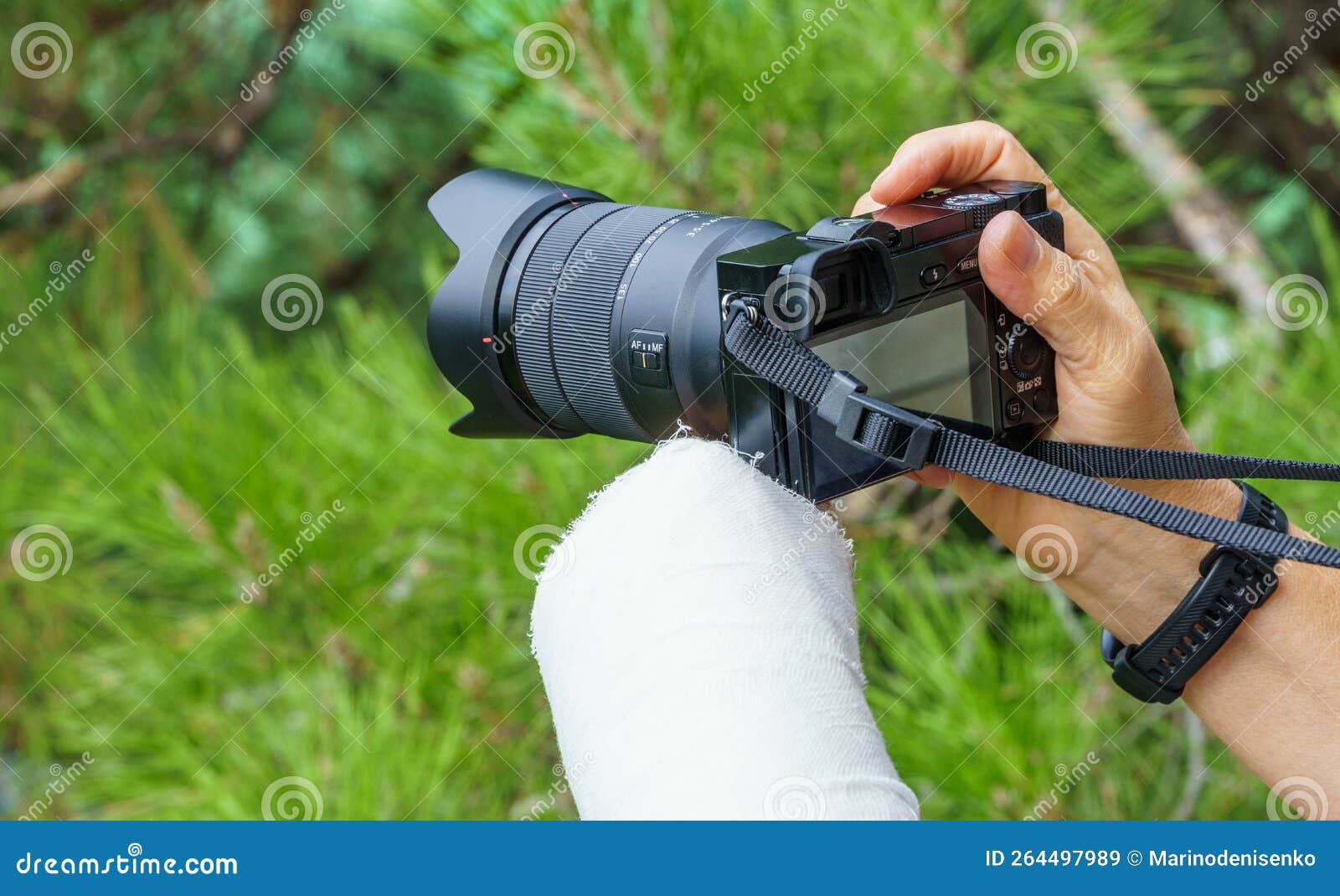 A Photographer with a Broken Arm in a White Plaster Cast Holding a Big ...