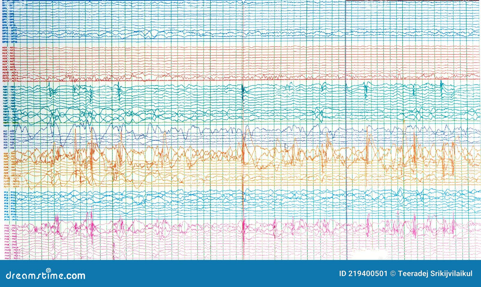 Photography of Brain Waves of Epileptic Patient Showing Sharp Wave ... Photography of Brain Waves of Epileptic Patient Showing Sharp Wave ...