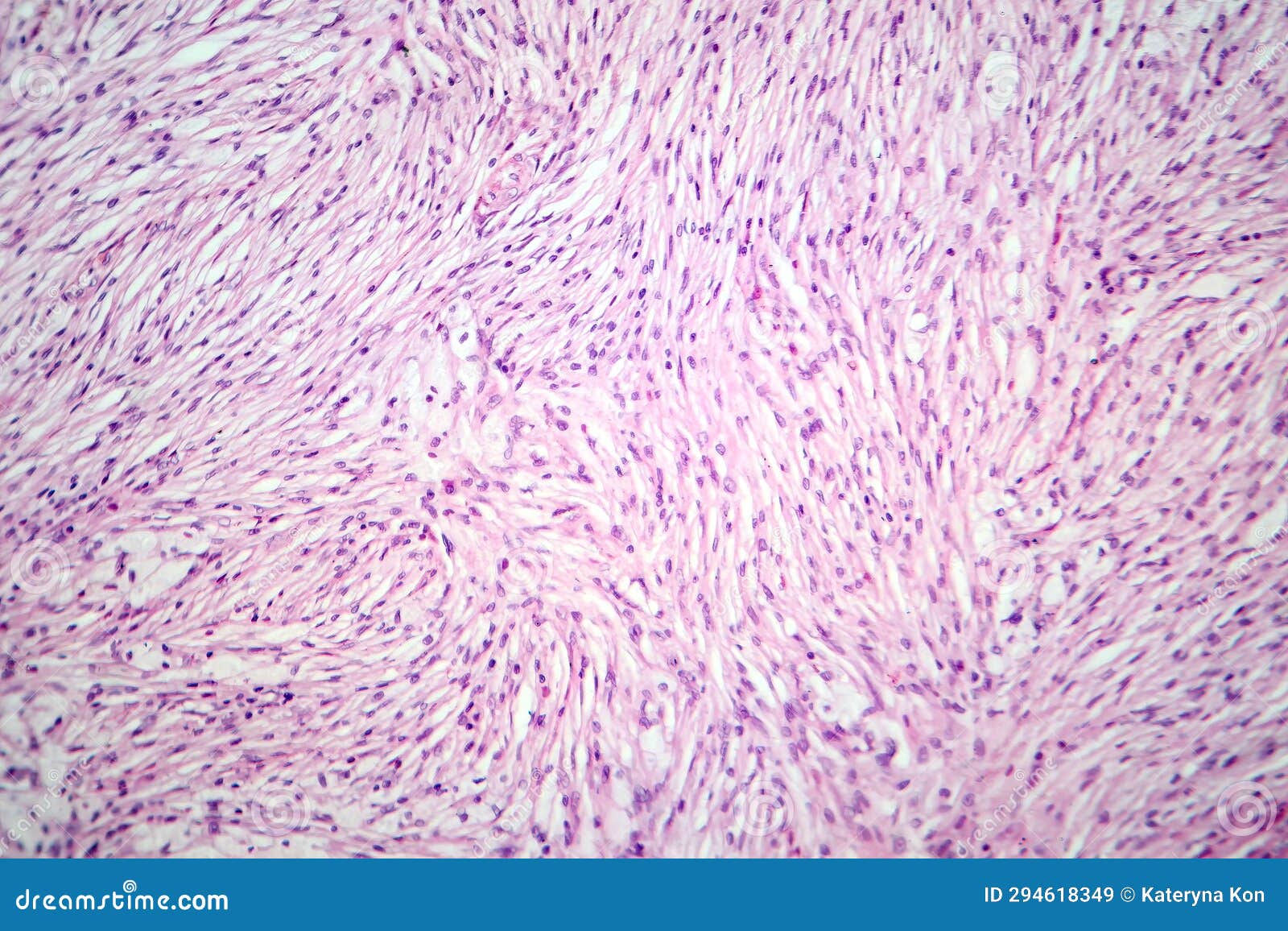Photomicrograph of a Giant Cell Tumor of Bone, Revealing Its Cellular Structure Under the ...