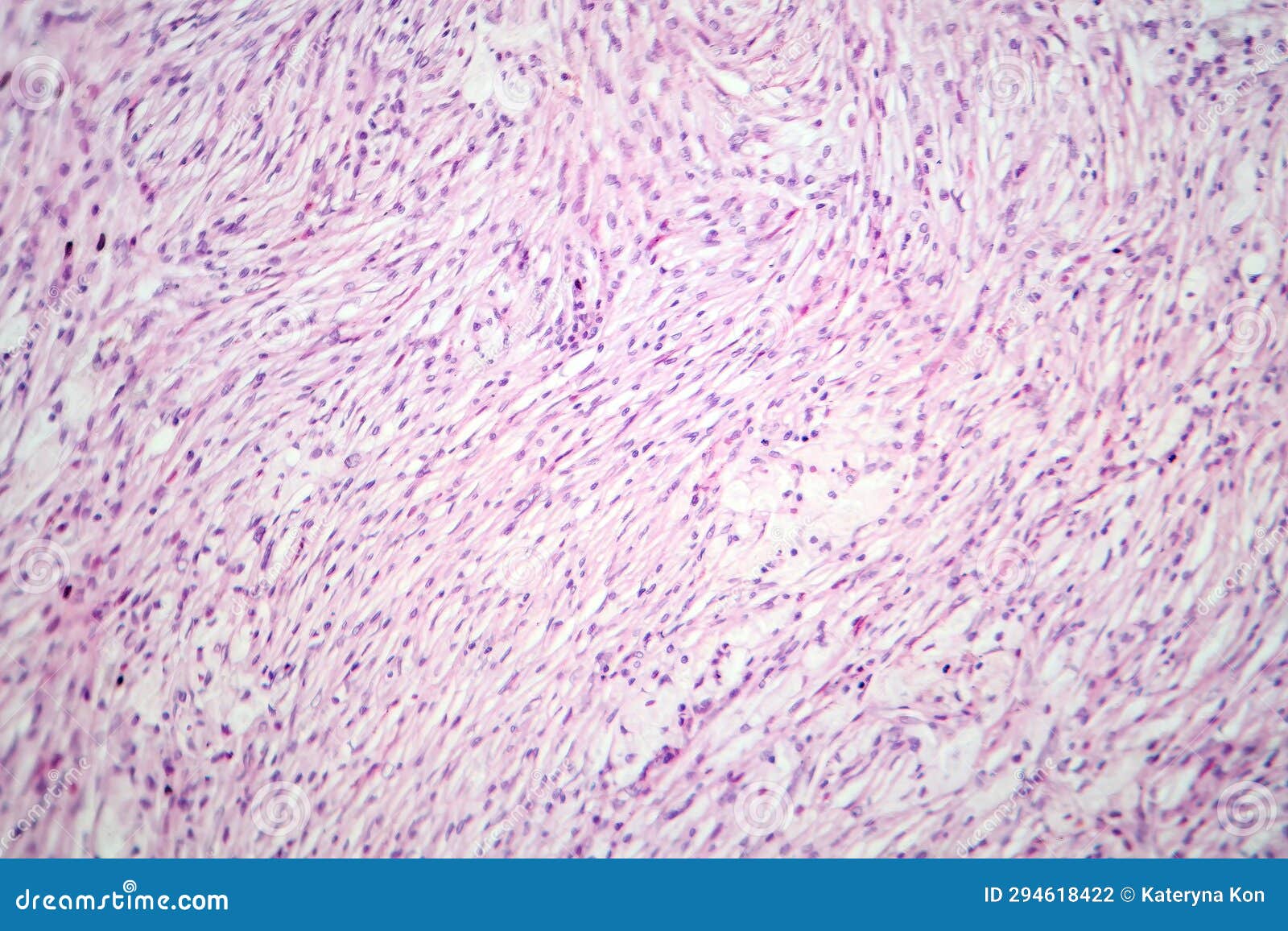 Photomicrograph Of A Giant Cell Tumor Of Bone, Revealing Its Cellular ...