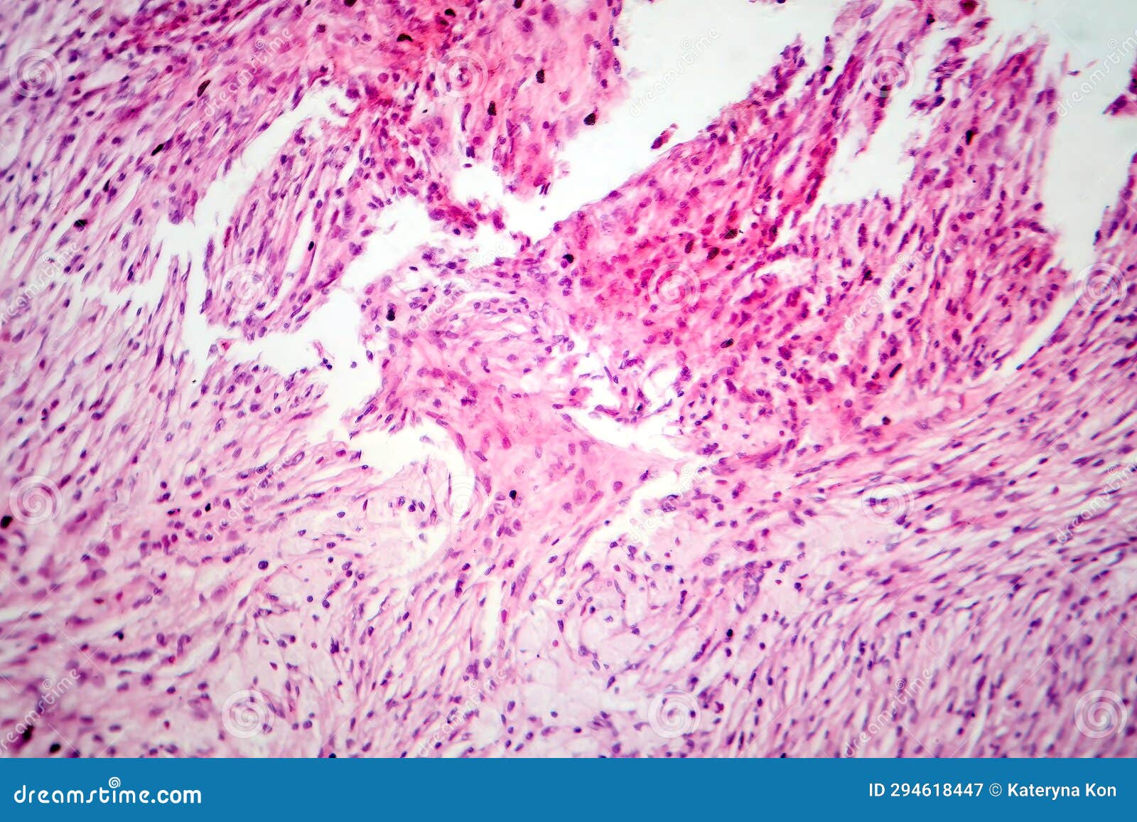 Photomicrograph Of A Giant Cell Tumor Of Bone, Revealing Its Cellular ...