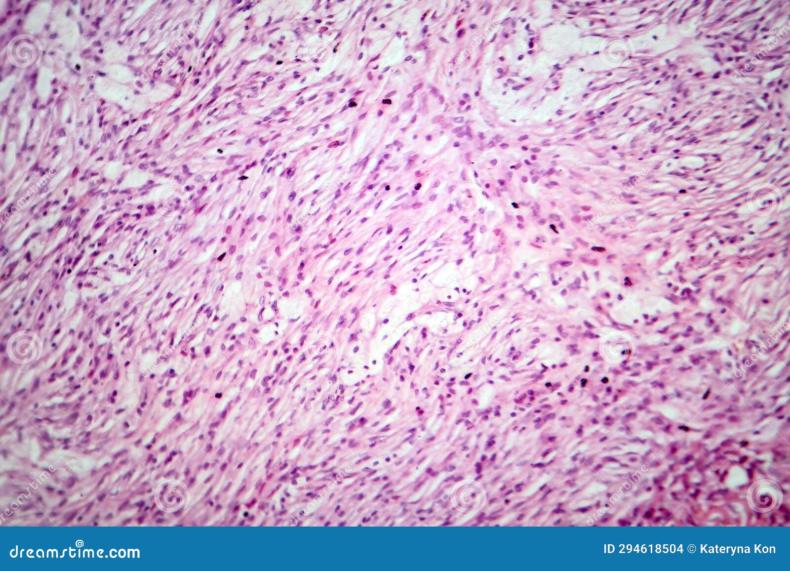 Photomicrograph of a Giant Cell Tumor of Bone, Revealing Its Cellular ...