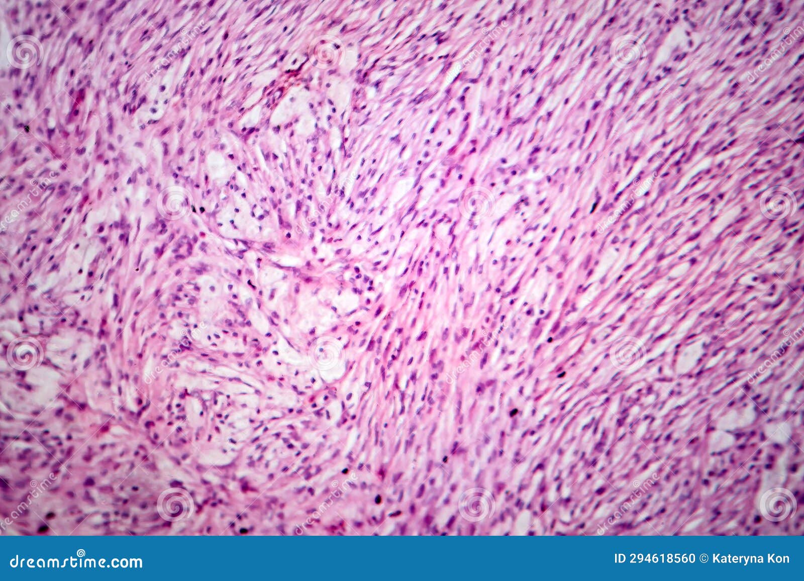 Photomicrograph Of A Giant Cell Tumor Of Bone, Revealing Its Cellular ...