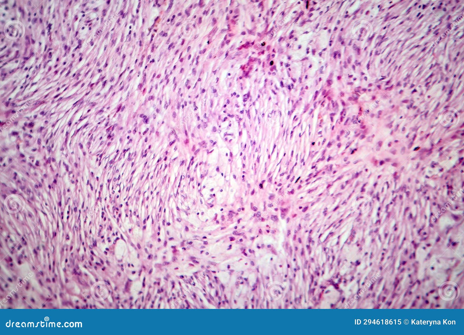 Photomicrograph Of A Giant Cell Tumor Of Bone, Revealing Its Cellular ...