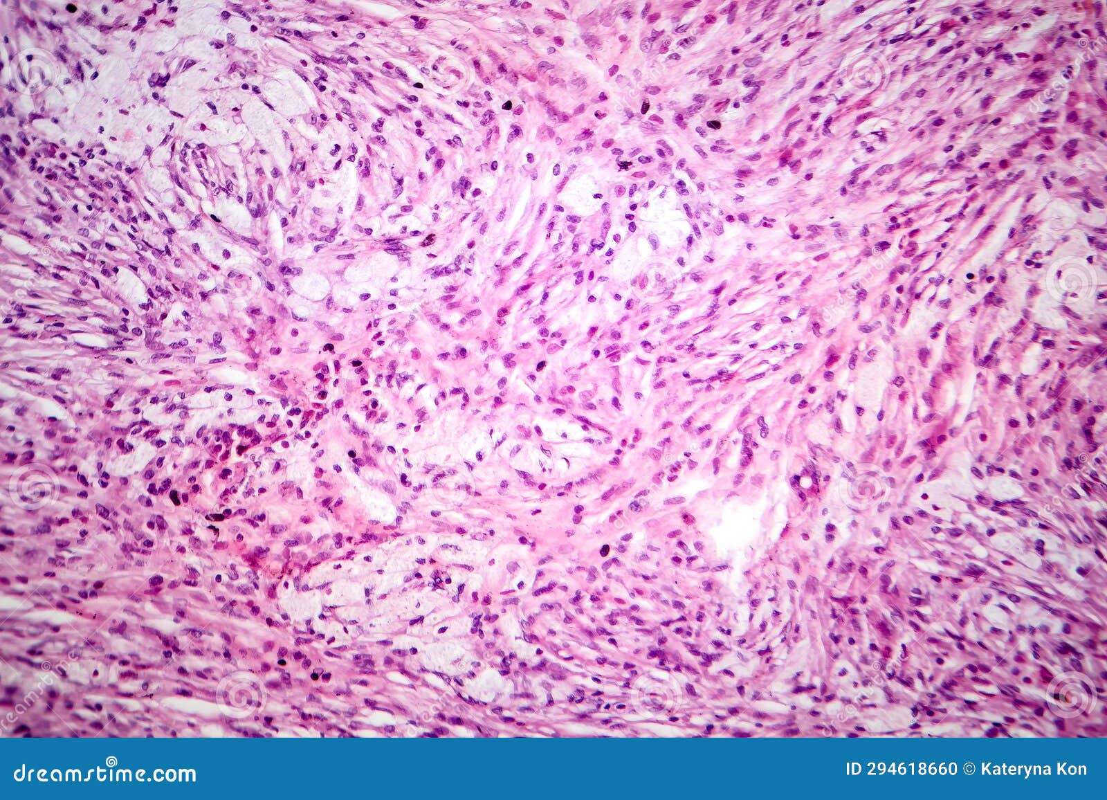 Photomicrograph of a Giant Cell Tumor of Bone, Revealing Its Cellular ...