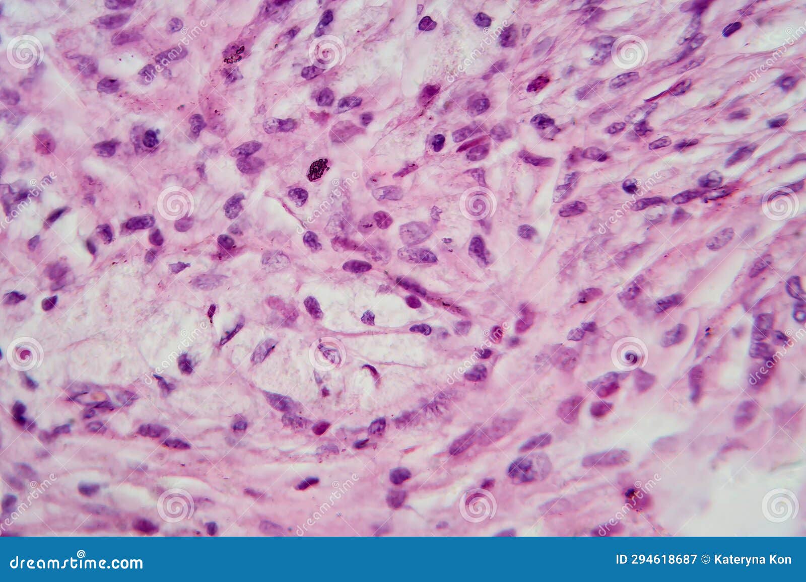 Photomicrograph of a Giant Cell Tumor of Bone, Revealing Its Cellular ...