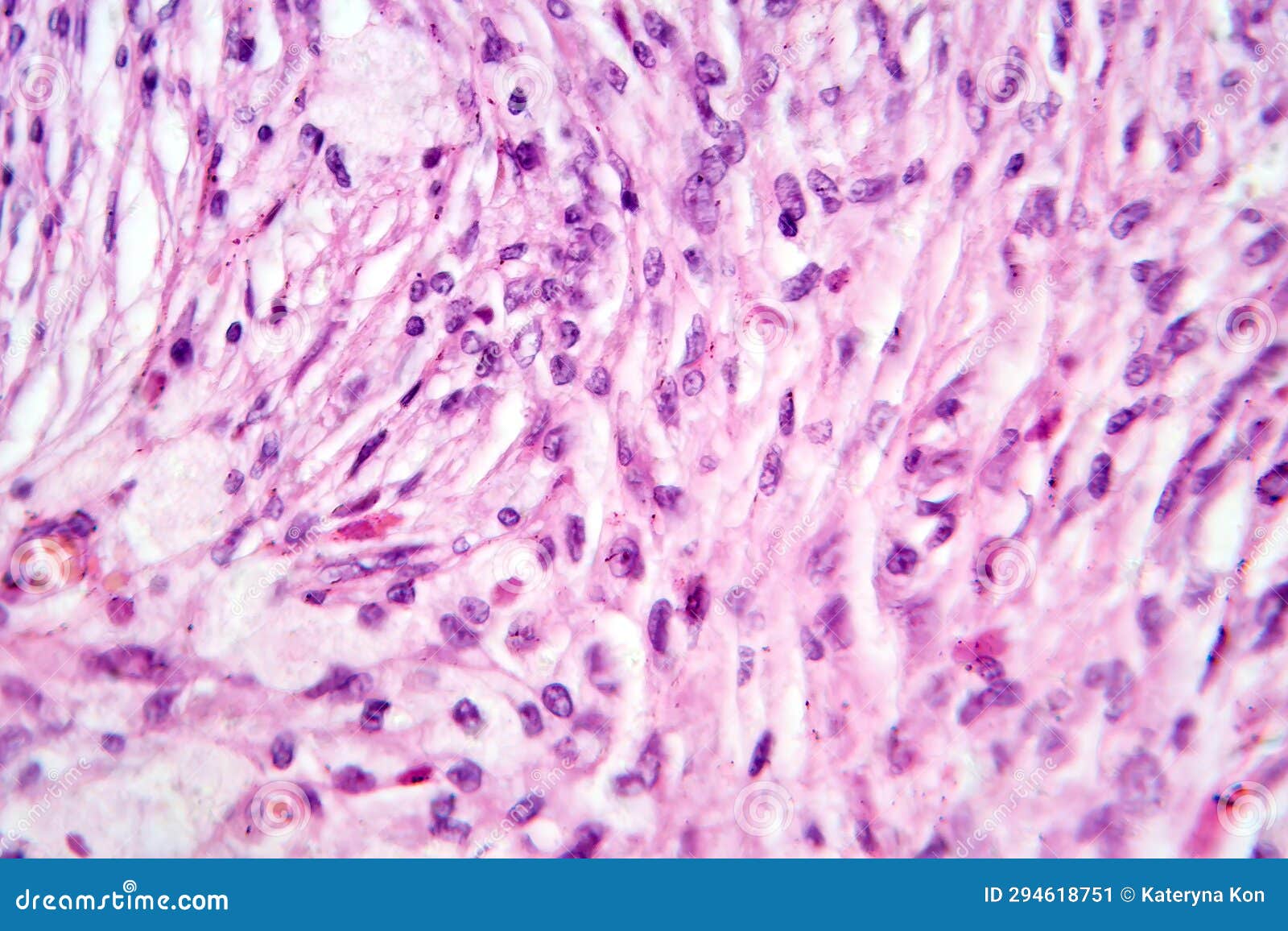 Photomicrograph Of A Giant Cell Tumor Of Bone, Revealing Its Cellular ...