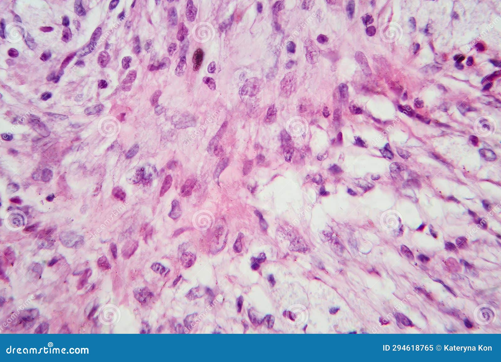 Photomicrograph of a Giant Cell Tumor of Bone, Revealing Its Cellular Structure Under the ...