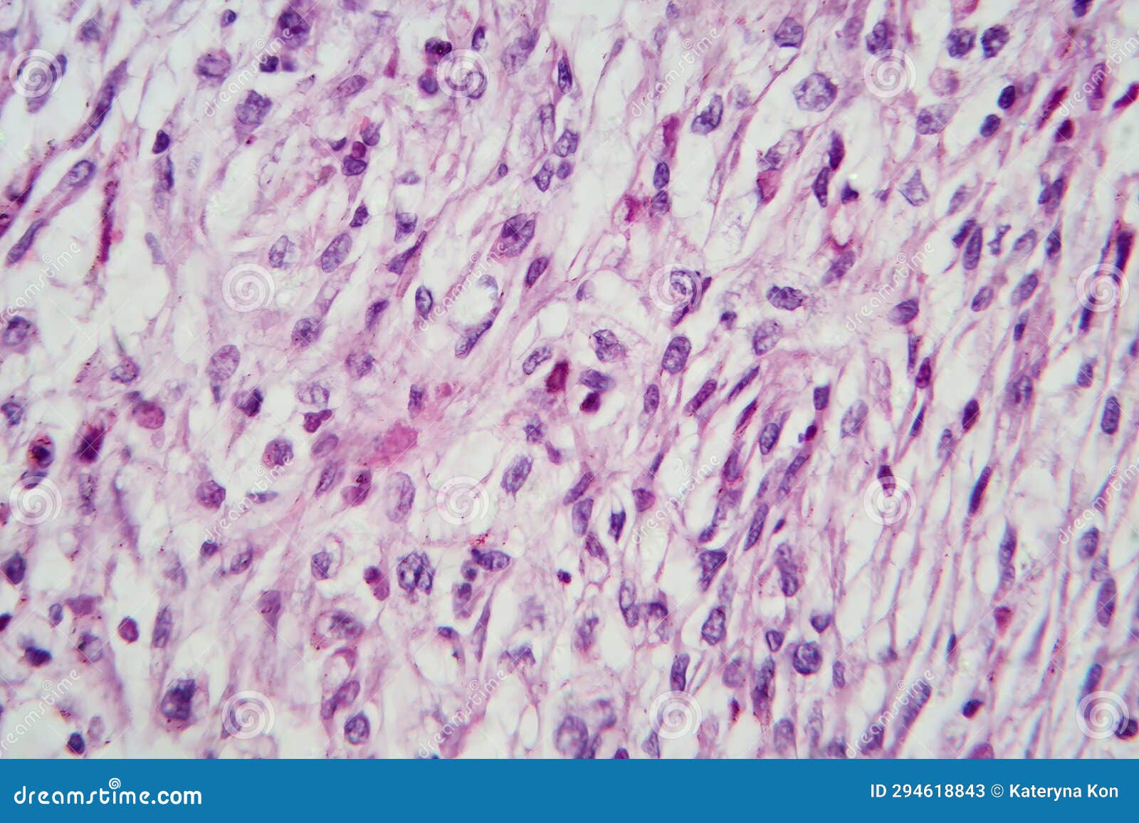 Photomicrograph of a Giant Cell Tumor of Bone, Revealing Its Cellular ...