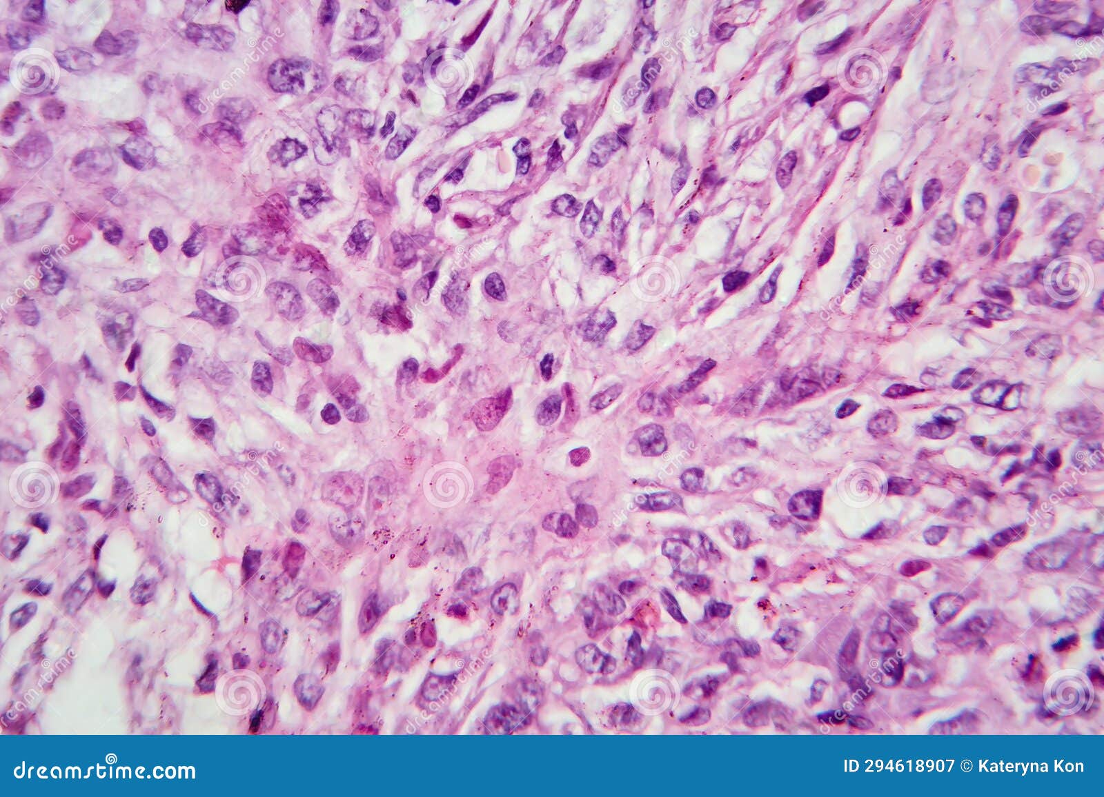 Photomicrograph Of A Giant Cell Tumor Of Bone, Revealing Its Cellular ...