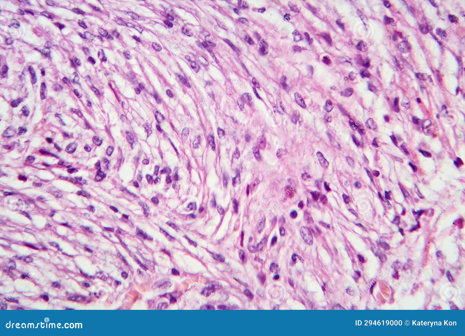 Photomicrograph of a Giant Cell Tumor of Bone, Revealing Its Cellular Structure Under the ...