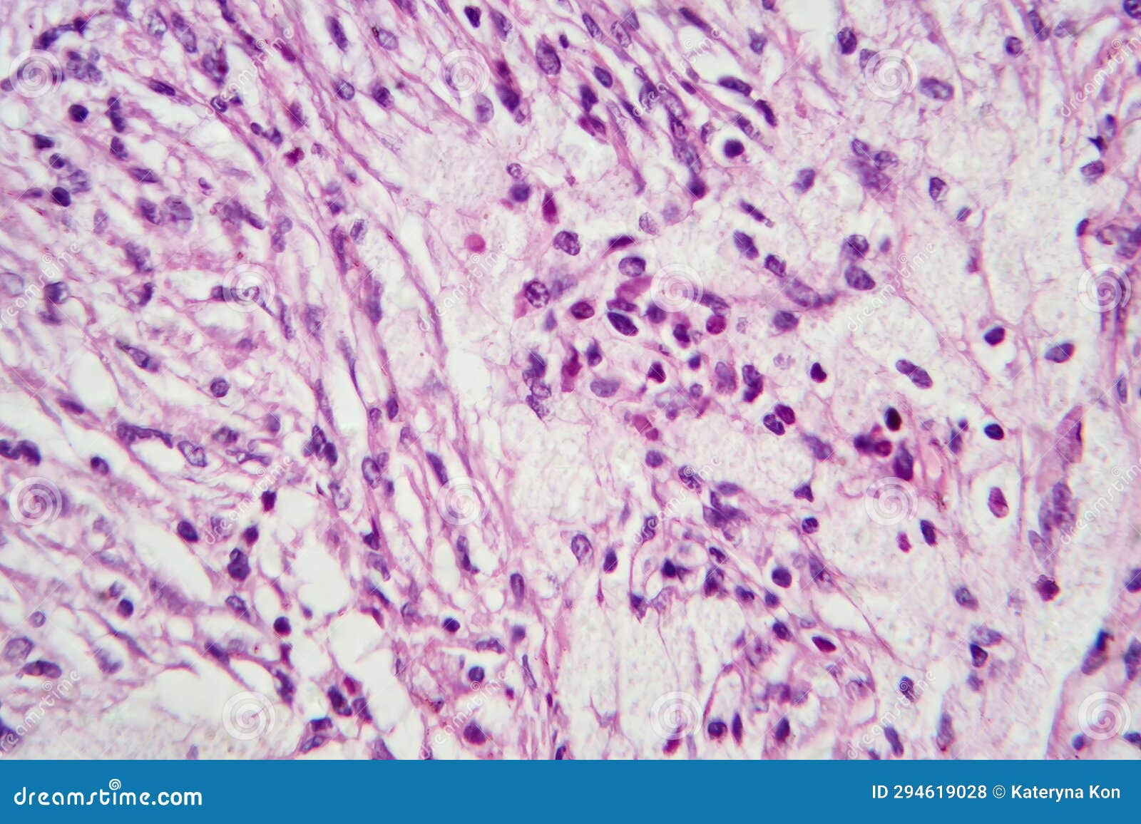 Photomicrograph of a Giant Cell Tumor of Bone, Revealing Its Cellular Structure Under the ...