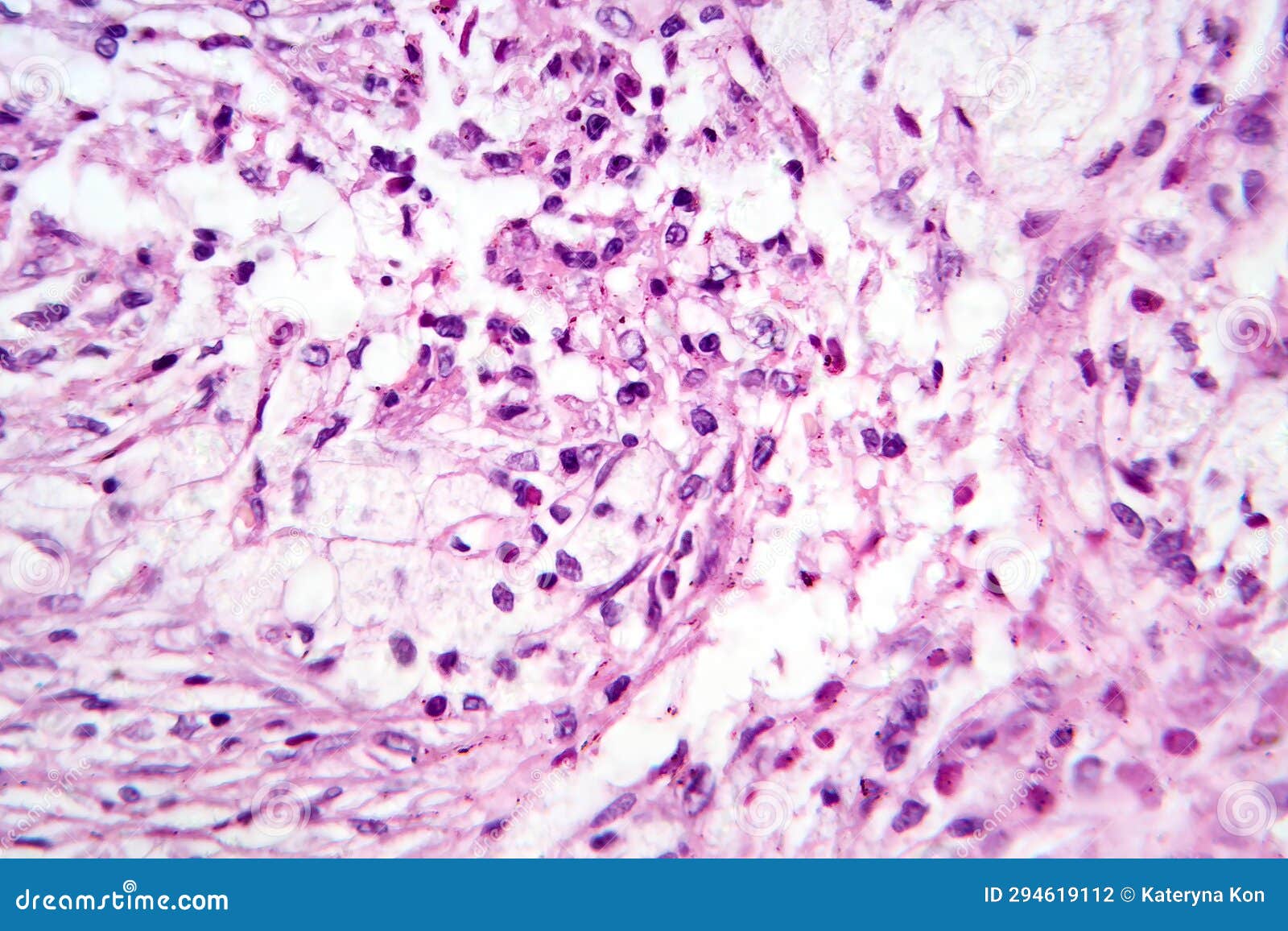 Photomicrograph Of A Giant Cell Tumor Of Bone, Revealing Its Cellular ...