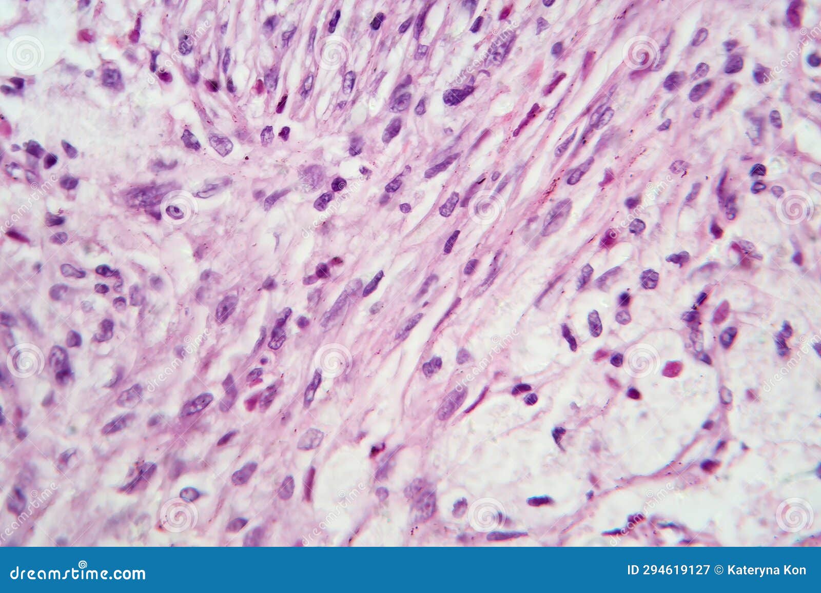 Photomicrograph Of A Giant Cell Tumor Of Bone, Revealing Its Cellular ...
