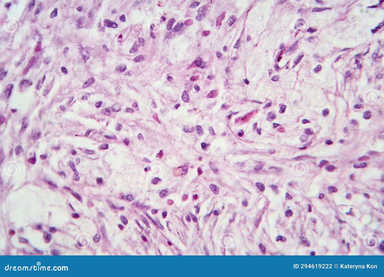 Photomicrograph of a Giant Cell Tumor of Bone, Revealing Its Cellular ...