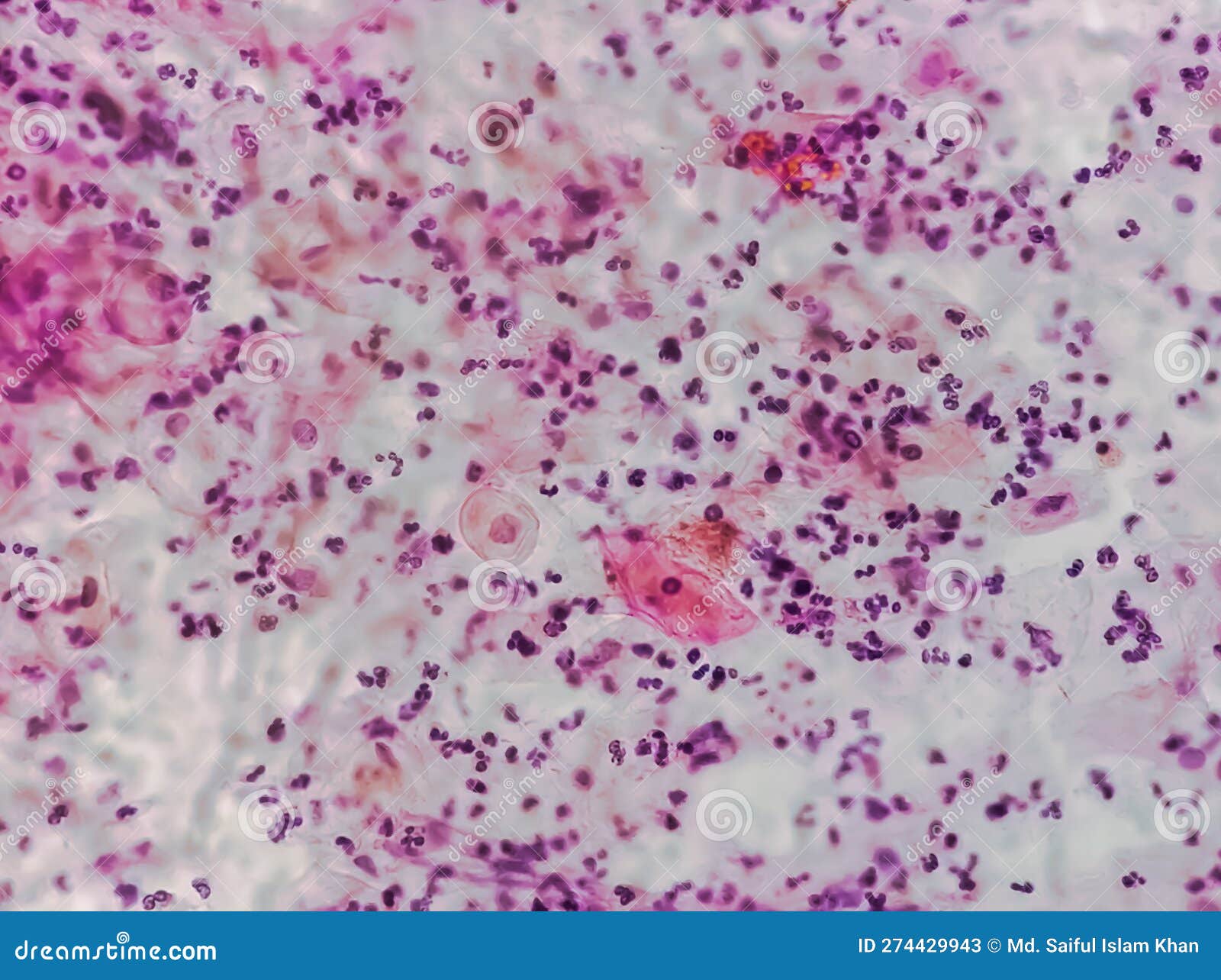 Photomicrograph Of Paps Smear: Inflammatory Smear With Vaginal ...