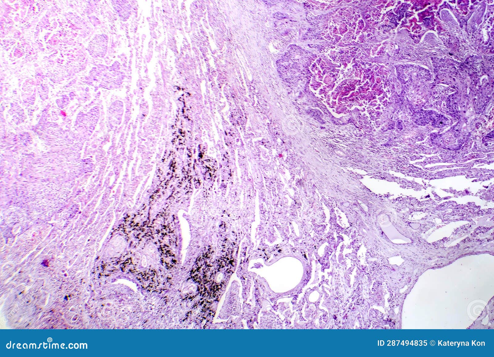 Squamous Cell Carcinoma of the Lung, Light Micrograph Stock Image ... Squamous Cell Carcinoma of the Lung, Light Micrograph Stock Image ...