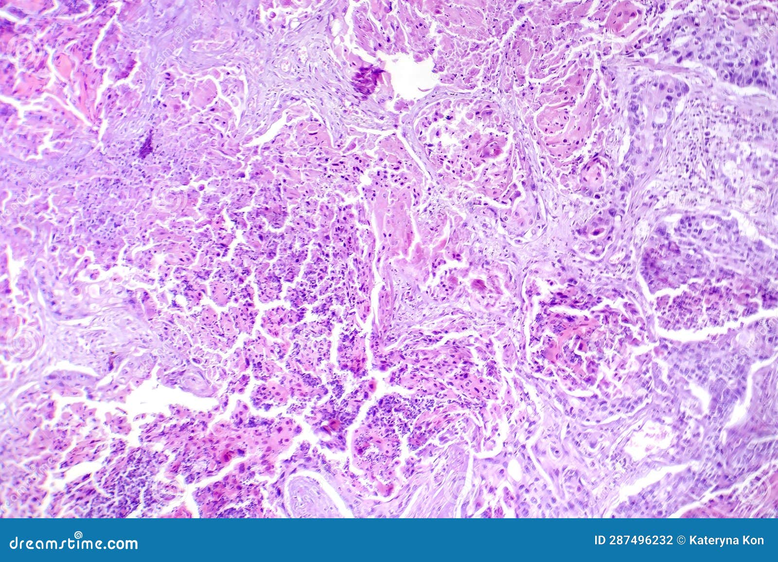 Squamous Cell Carcinoma of the Lung, Light Micrograph Stock Photo ... Squamous Cell Carcinoma of the Lung, Light Micrograph Stock Photo ...
