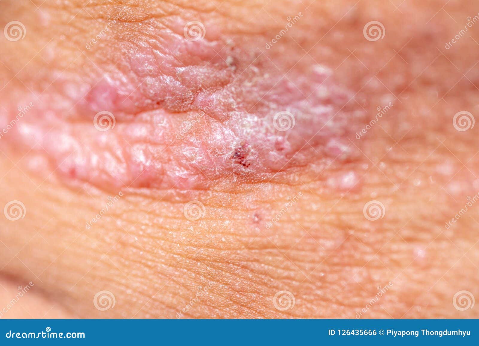 Atopic Dermatitis AD, Also Known As Atopic Eczema, is a Type of ...
