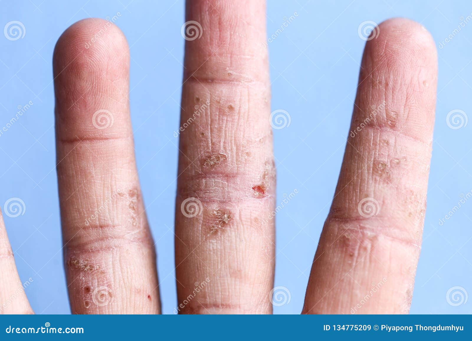 Atopic Dermatitis AD, Also Known As Atopic Eczema, is a Type of ...