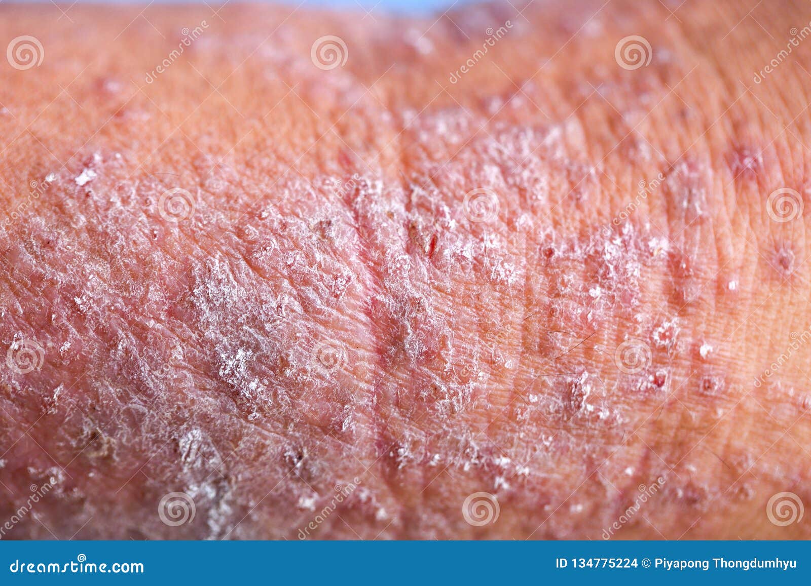 Atopic Dermatitis Ad Also Known As Atopic Eczema Is A Type Of