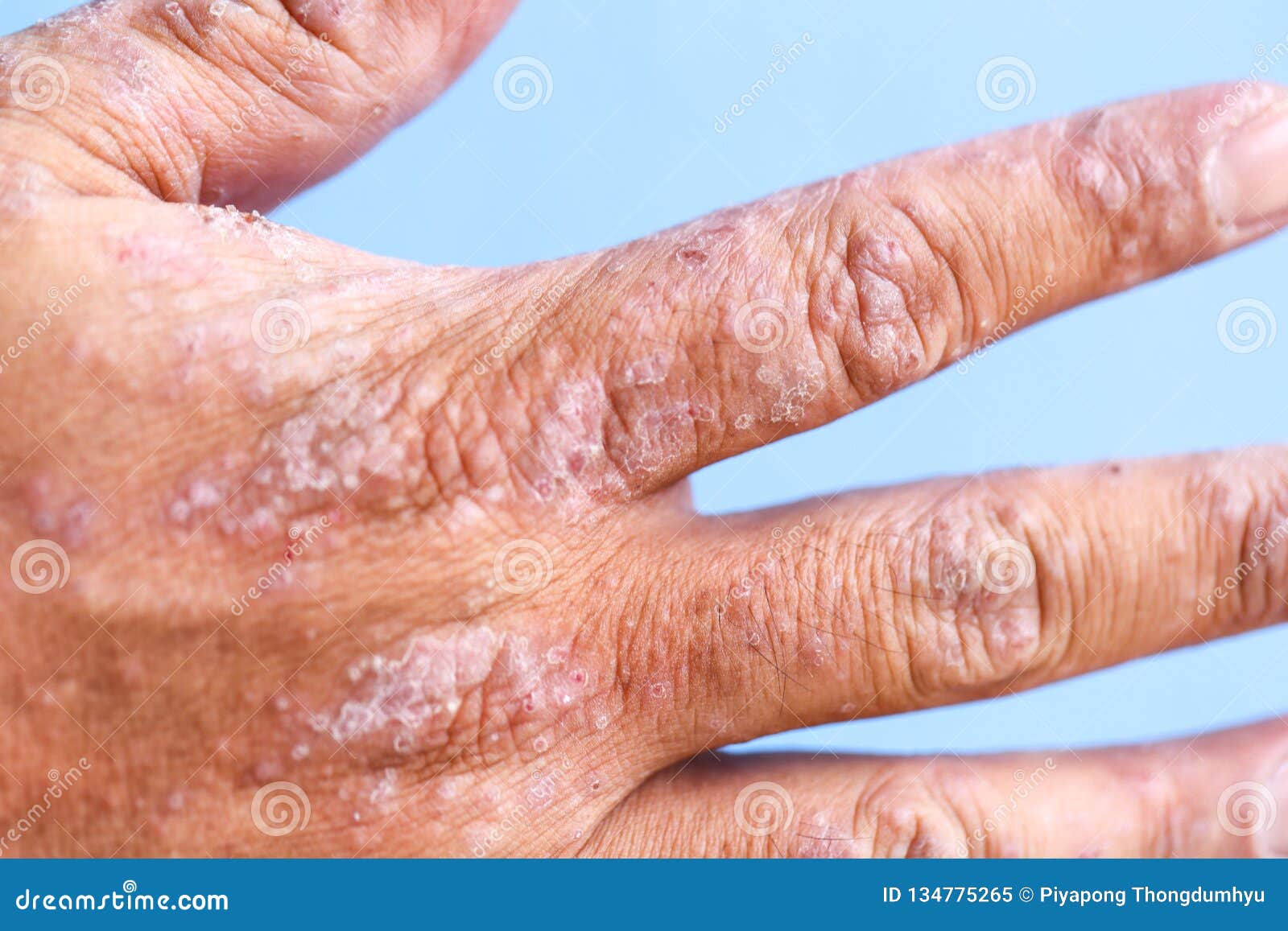 Atopic Dermatitis Ad Also Known As Atopic Eczema Is A Type Of