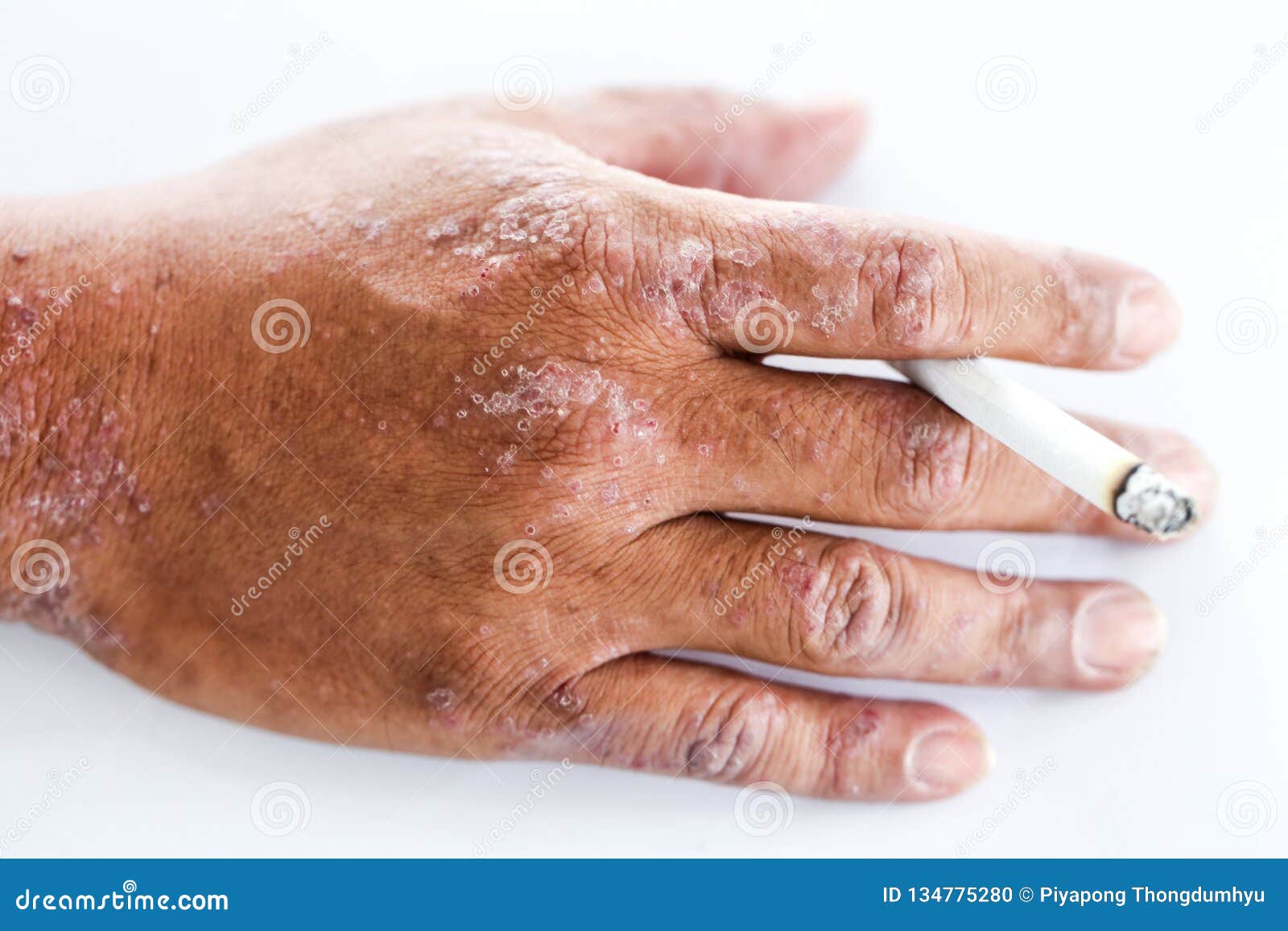 Atopic Dermatitis Ad Also Known As Atopic Eczema Is A Type Of
