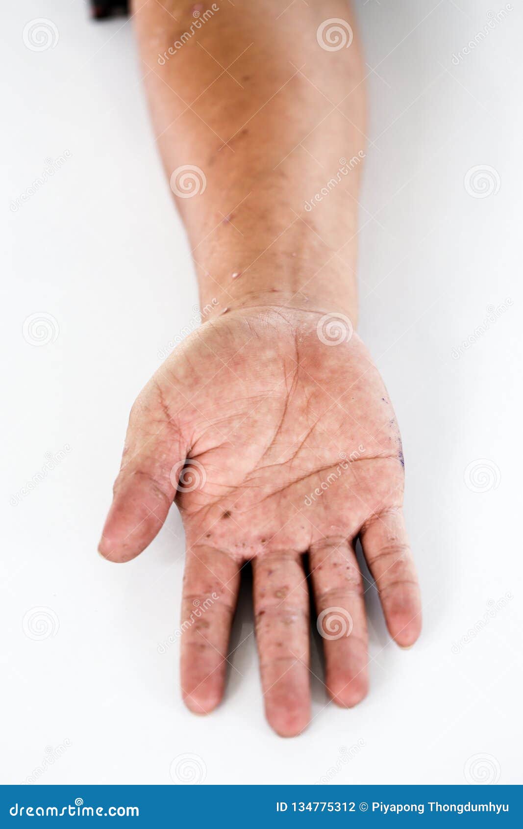 Atopic Dermatitis AD, Also Known As Atopic Eczema, is a Type of ...